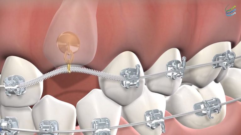 What you need to know about gold chain bonding for impacted teeth - My ...